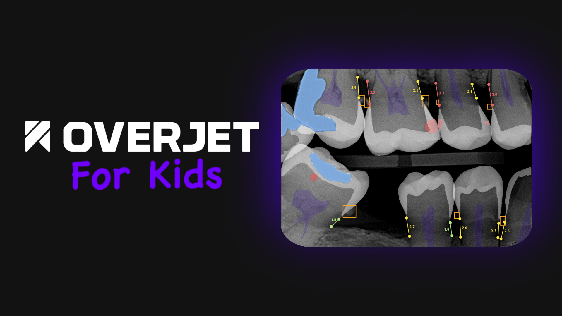 Overjet for Kids