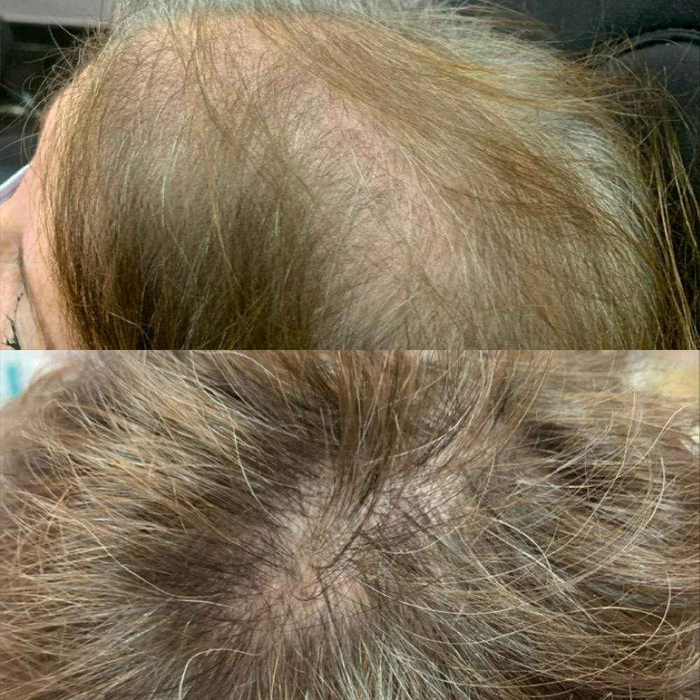 PRP for Hair Before and After | Skin Matrx