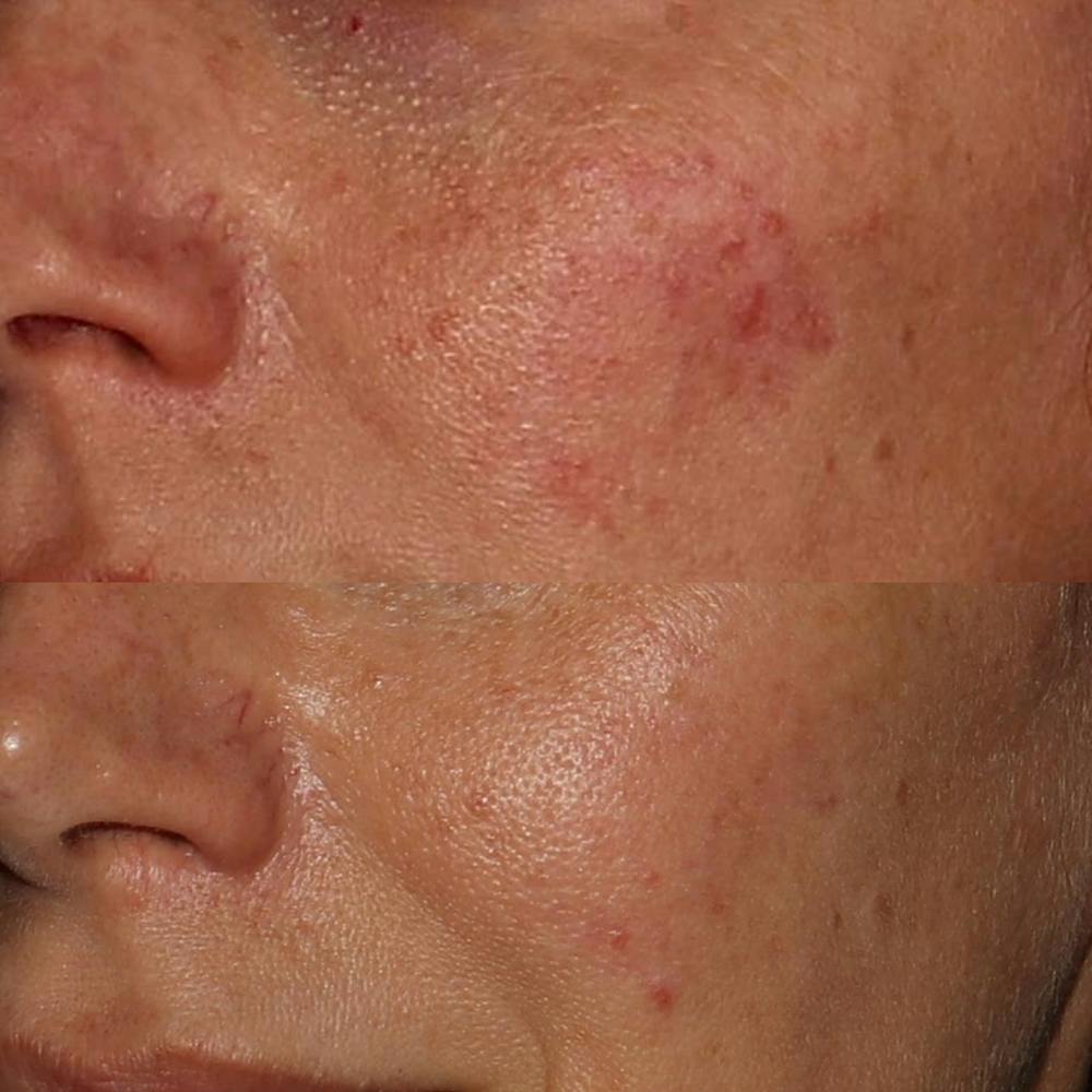 V Beam Gallery | Skin Matrx