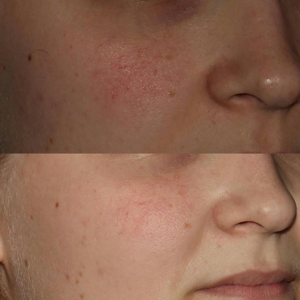 V Beam Gallery | Skin Matrx