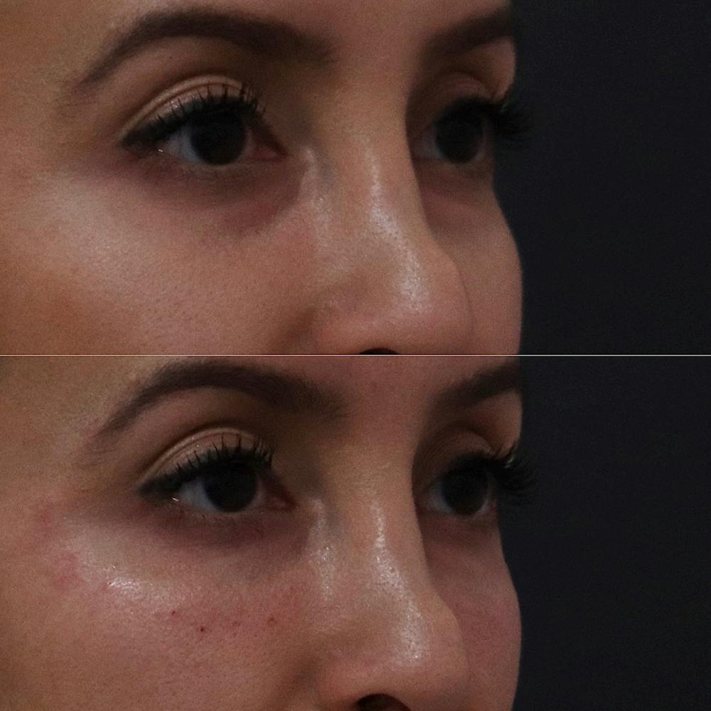 Eye Dermal Fillers Gallery | Skin Matrx